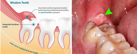 Oral Surgery Wisdom Teeth Lebians Sex