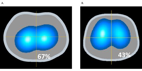 Monitoring Lung Function With Electrical Impedance Tomography In The Intensive Care Unit