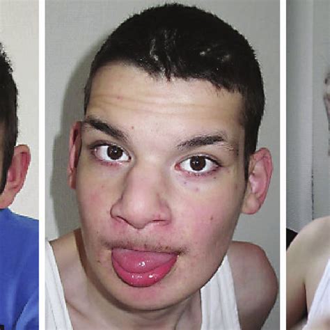 Photographs Of The Patients Showing Dysmorphic Facial Features Download Scientific Diagram