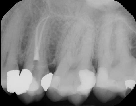 Glide Path Revisited Are Hand Files Needed In Modern Endodontic