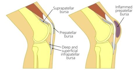 Housemaids Knee Causes Symptoms And Treatment Options
