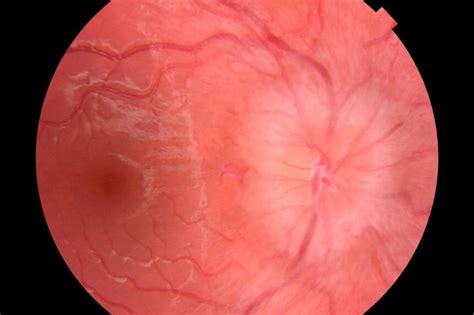 Papilledema Vs Normal