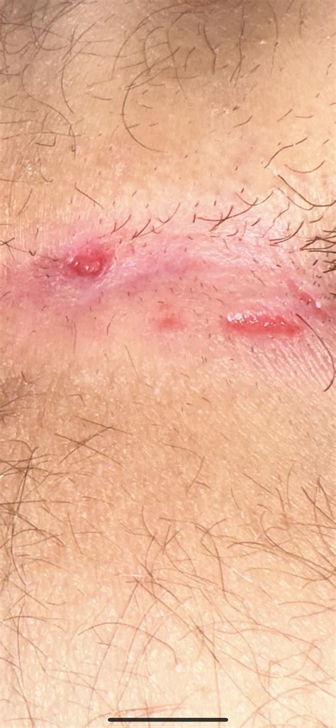 Advice Needed Unsure If This Is A Pilonidal Cyst Rpilonidalcyst