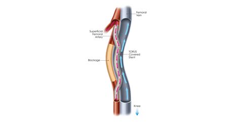 Pq Bypass Completes Enrollment In Detour2 Percutaneous Femoral