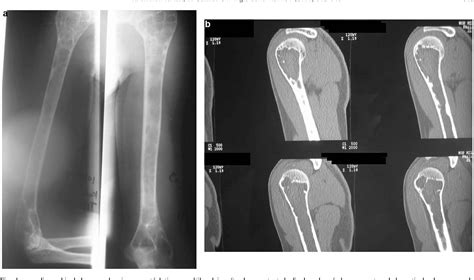 Figure 1 From Kyste Osseux Anévrismal Pandiaphysaire De Lhumérus à Propos Dun Cas Semantic