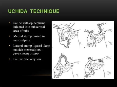 Female Sterilisation