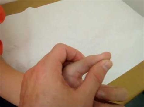 Pronator Syndrome Compression Of The Proximal Median Nerve YouTube