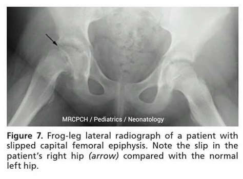 Frog Leg Slipped Capital Femoral Epiphysis Bone Diseases Neonatology
