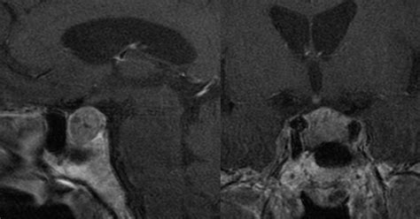 Sagittal T1 Multi Echo Multiplanar Memp Spin Echo Se 3 Mm Slice Download Scientific Diagram