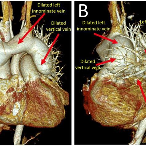 A Three Dimensional Cardiac Ct Scan Further Delineated The Supracardiac