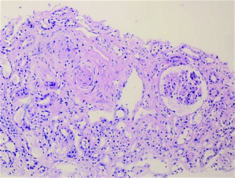 Fragmented Red Blood Cells On A Blood Vessel Wall In The Middle Of