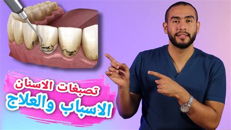 تصبغات الاسنان السوداء اسبابها وعلاجها 🦷💯علاج تصبغات الاسنان عند