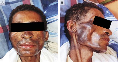 Cutaneous Melanosis In Peripheral Cortisol Resistance New England