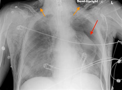 Keeping Patients Safe During Emergency Tracheostomy Management Anesthesia Patient Safety