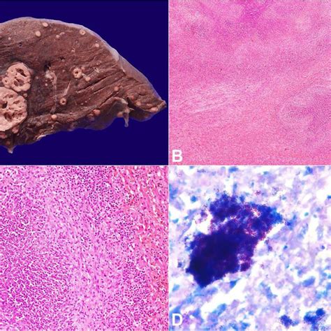 A Gross View Of Enlarged Matted Para Aortic Lymph Nodes With