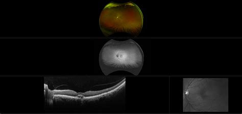 Retinal Nevus Icd 9 Code