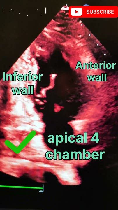 Mi Heart Attack Wall Of The Heart 17 Segment Of Echo Echocardiography