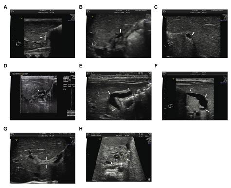 A The Gallbladder Is Not Identifiable B The Length Is Less Than