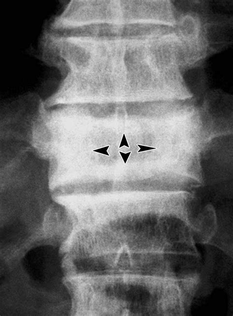 Pagets Disease Spine
