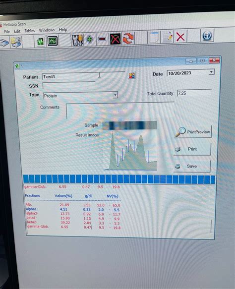 Proteinelectrophoresis Medicalscience Diagnostics Dr Joseph