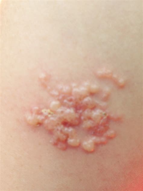 Hook Worms In Human At Sandra Slavin Blog