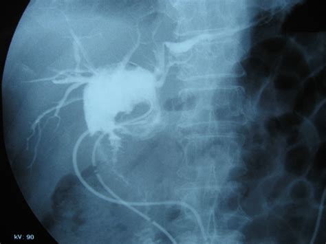 Extended High Hilar Resection And Enlarged Hepatic Portal Enterostomy In The Treatment Of Hilar
