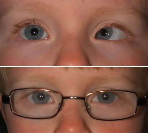 Die Ursache Des Strabismus Convergens Concomitans Lzrnn