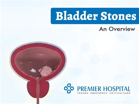 Urinary Bladder Stones In Men Bladder Stones Symptoms Ajiv