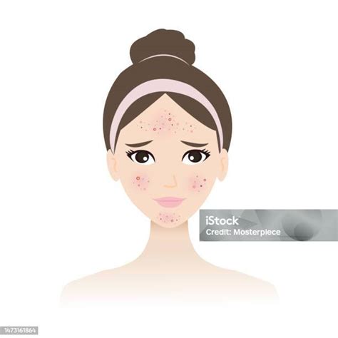 흰색 배경에 격리된 피부 여드름 벡터 삽화를 가진 여자 얼굴 블랙헤드에 대한 스톡 벡터 아트 및 기타 이미지 블랙헤드 보살핌 문제 Istock