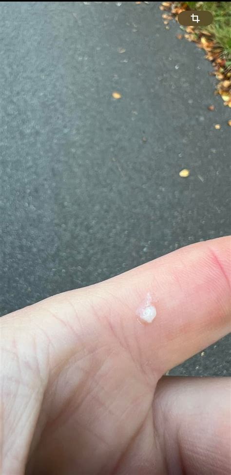 Thick White Glue Mucus From Nose Rsinusitis