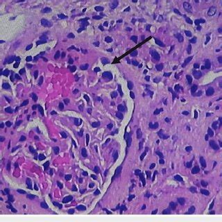 Renal Biopsy Demonstrating Diffuse Glomerular Sclerosis Fibrin Download Scientific Diagram