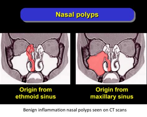 Nasal Polyps Treatment In Singapore Fungus Removal Surgery