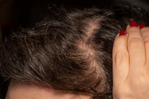 Uncovering Psoriatic Patches On The Scalp Highlighting Symptoms And