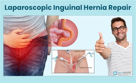 Inguinal Herniorrhaphy