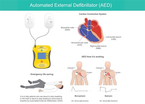 Synchronized Cardioversion Treating Rapid Arrhythmias