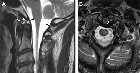 Anatomy And Nontraumatic Pathologies Of The Craniocervical Junction