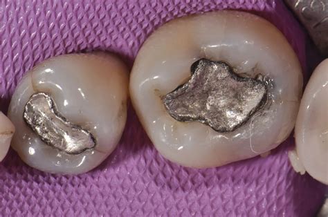 Recurrent Tooth Decay