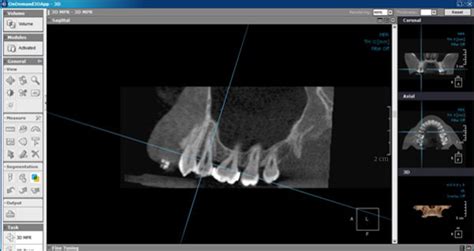 ANS PNS Plane Aligned At The Level Of CEJ Of Download Scientific Diagram