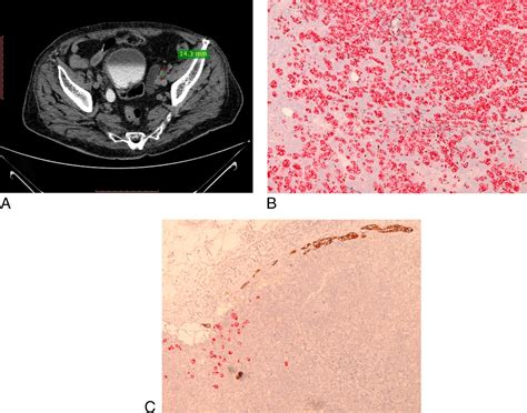 Collision Nodal Metastasis Of Bladder Cancer And Melanoma T