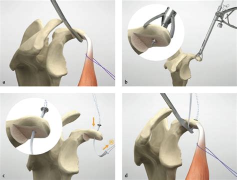 27 The Guided All Arthroscopic Latarjet Procedure Using Cortical Button Fixation