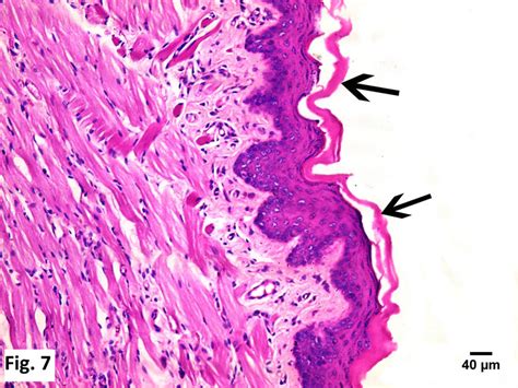 Separation Of The Keratin Layer From The Underlying Epithelium Of The Download Scientific