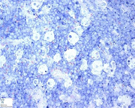 Nodal Burkitt Lymphoma Human Pathology