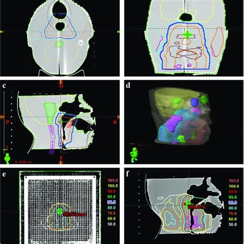 Pdf Feasibility Of A 3d Printed Anthropomorphic Patient Specific Head Phantom For Patient