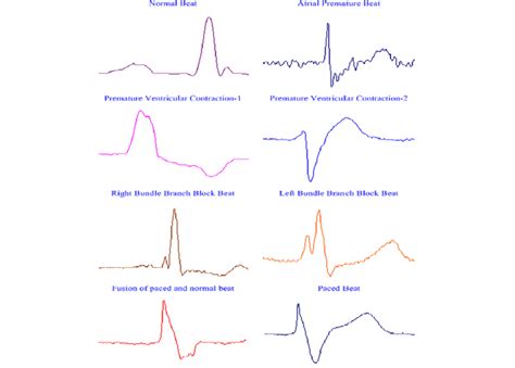 Typical Arrhythmia Heartbeats In Time Domain Lead Ii Signal Download Scientific Diagram