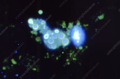 Cryptococcus Neoformans Fungus From Nasal Sample Light Micrograph