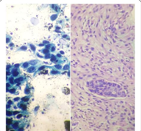 Lung Squamous Cell Carcinoma Treatment Guidelines At Alejandra Henning Blog