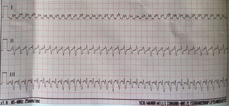 Chest Flutter Felikvox