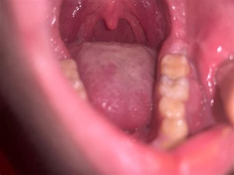 My Wisdom Teeth Are Coming In But I Also Have A Cracked Tooth Rteethcare