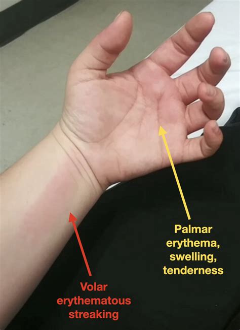 Cellulitis Thumb