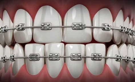 Metal Braces How They Work Cost And The Types